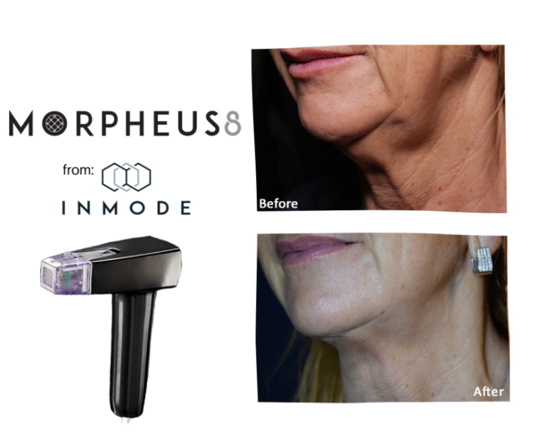 Morpheus8 RF Microneedling - Benefits, Costs, Results & Procedure Steps