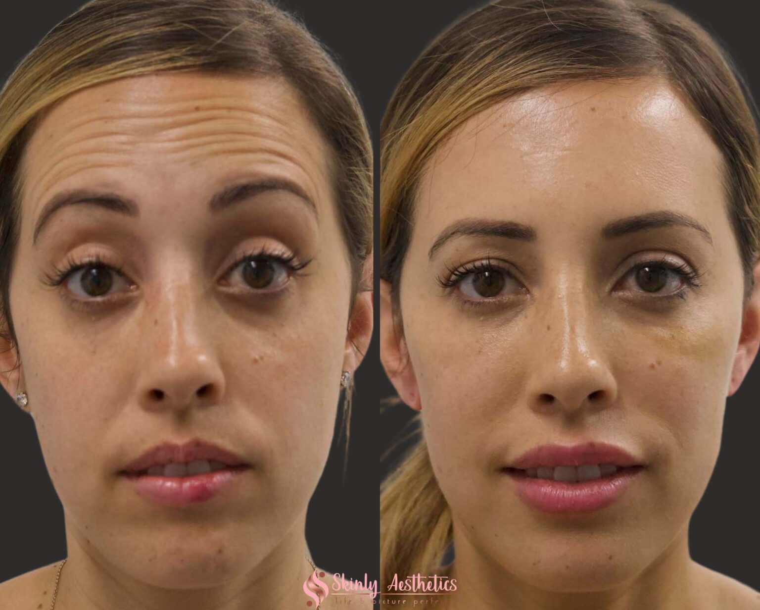 Botox Eyebrow Lift - Benefits, Costs, Results & Procedure Steps