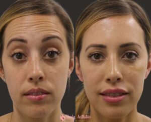 Botox Eyebrow Lift - Benefits, Costs, Results & Procedure Steps