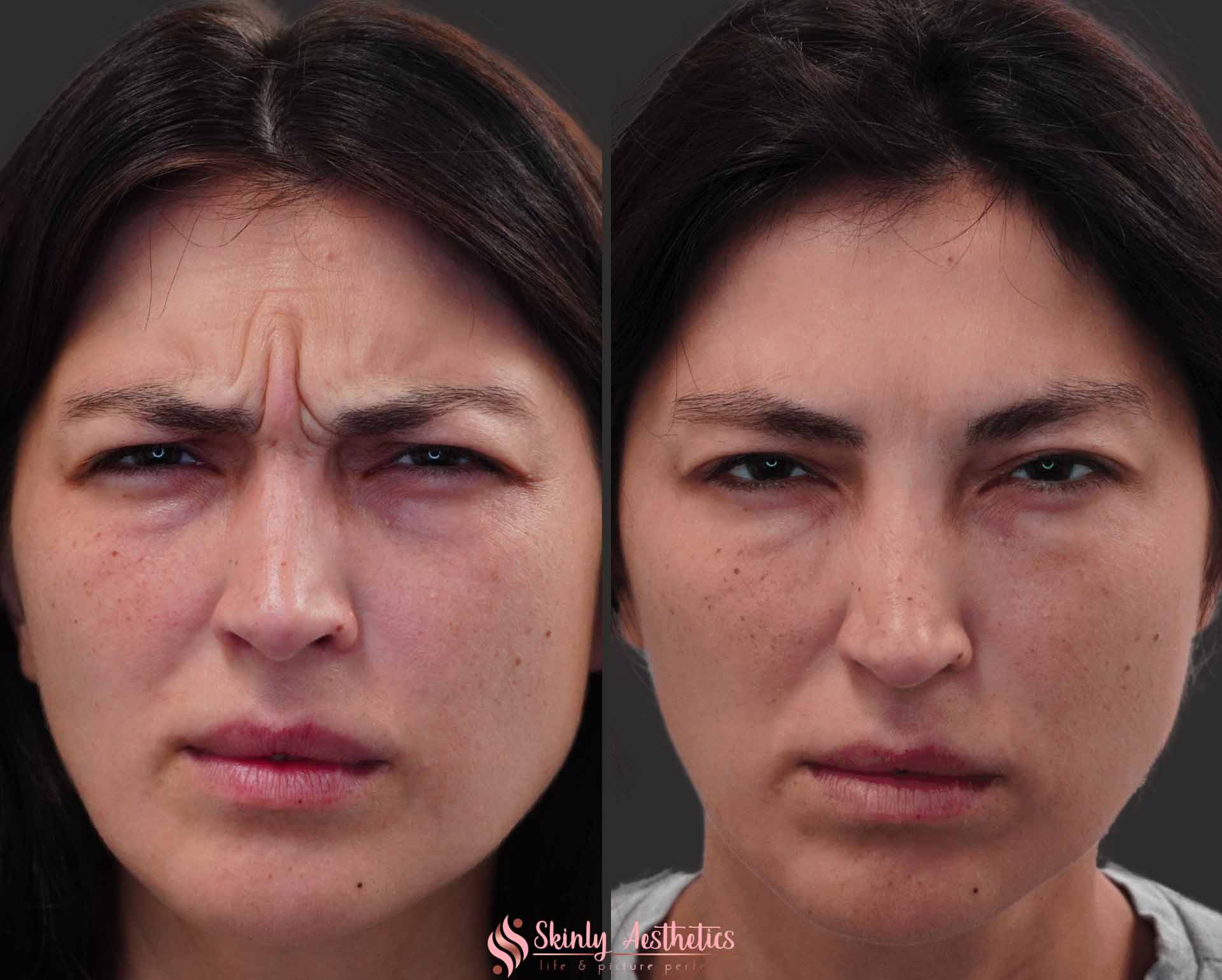 Botox Before and After Results - Everything You Need to See & Know