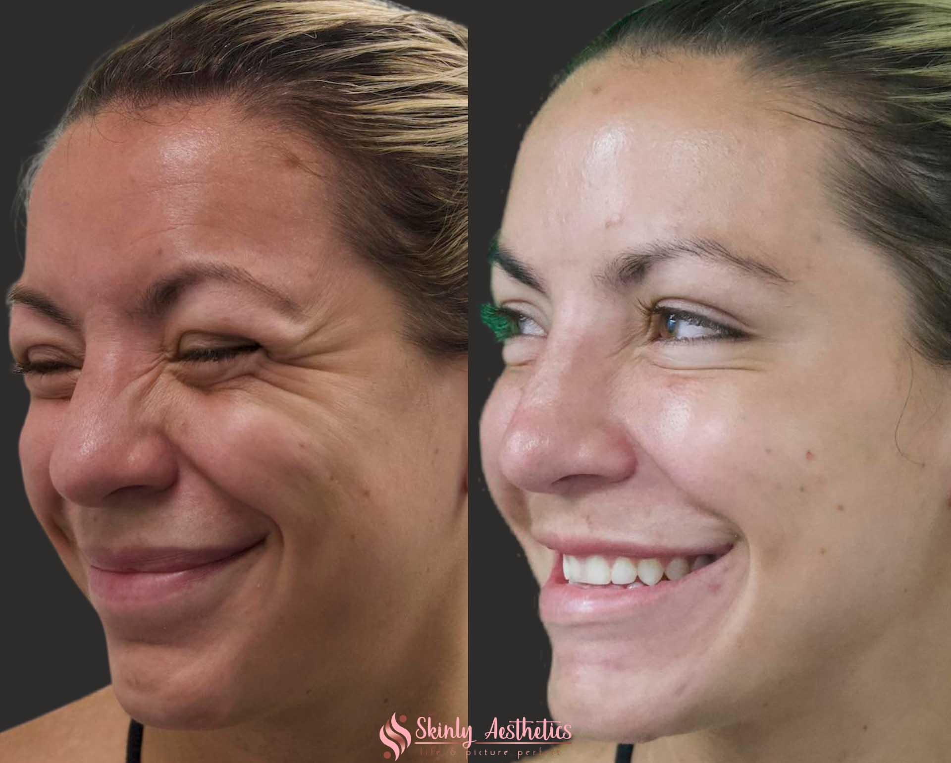 Botox Before and After Results - Everything You Need to See & Know