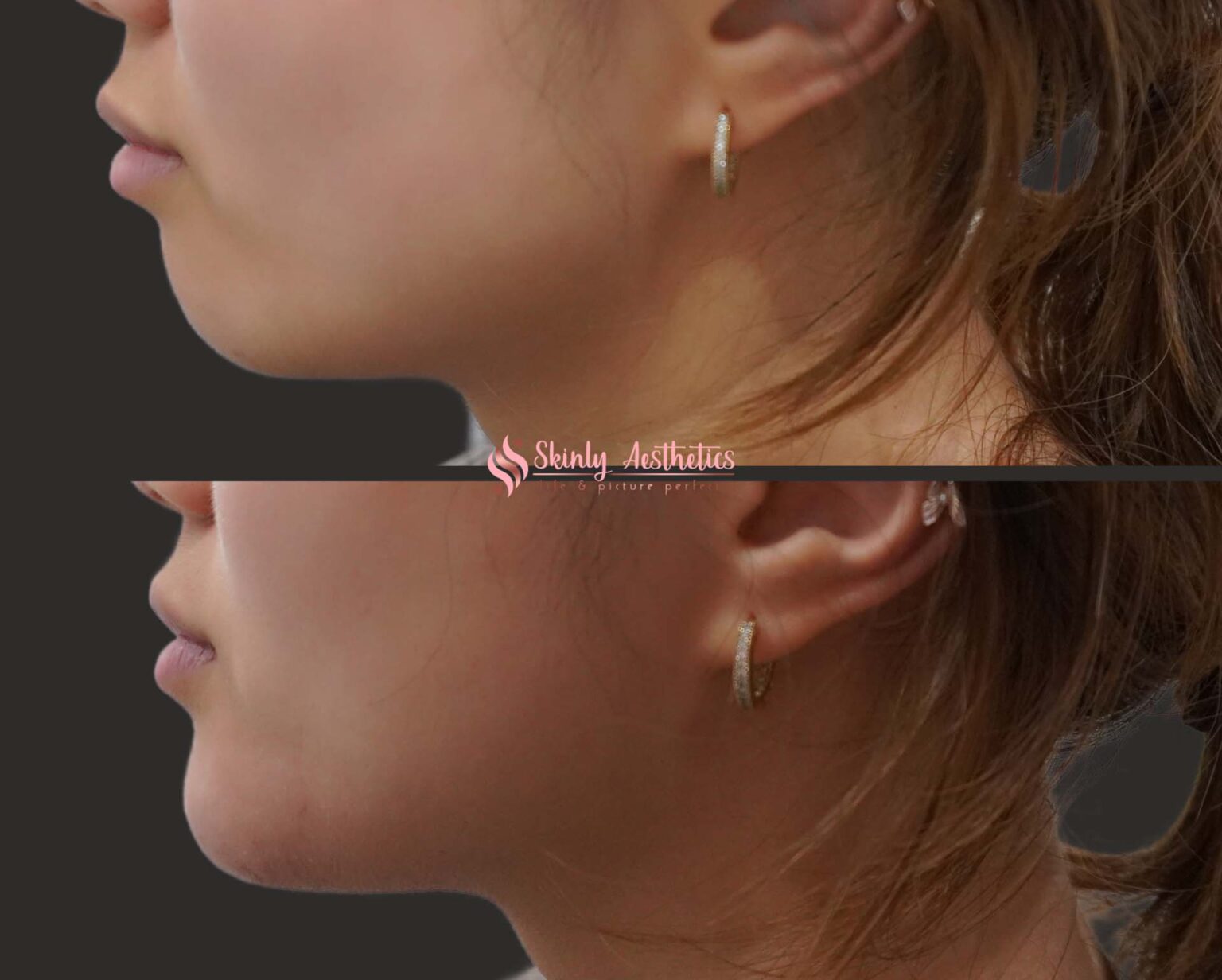 Chin Filler Injections - Benefits, Cost, Results & Procedure Steps