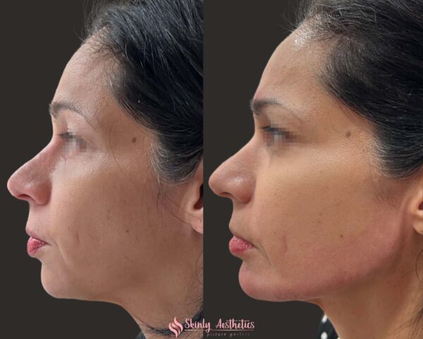 Chin Filler Injections - Benefits, Cost, Results & Procedure Steps