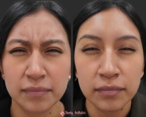 Botox Injections - Benefits, Costs, Results & Procedure Steps