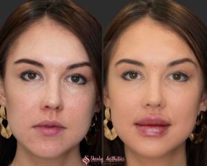 Russian Lip Filler Technique - Benefits, Costs & Results