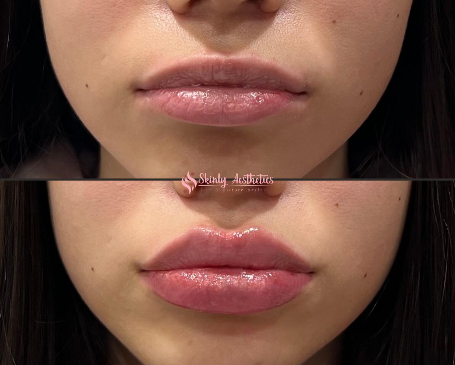 Russian Lip Filler By MD | $800 | Book Now