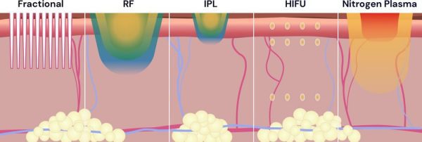 Plasma Skin Resurfacing - All You Need To Know