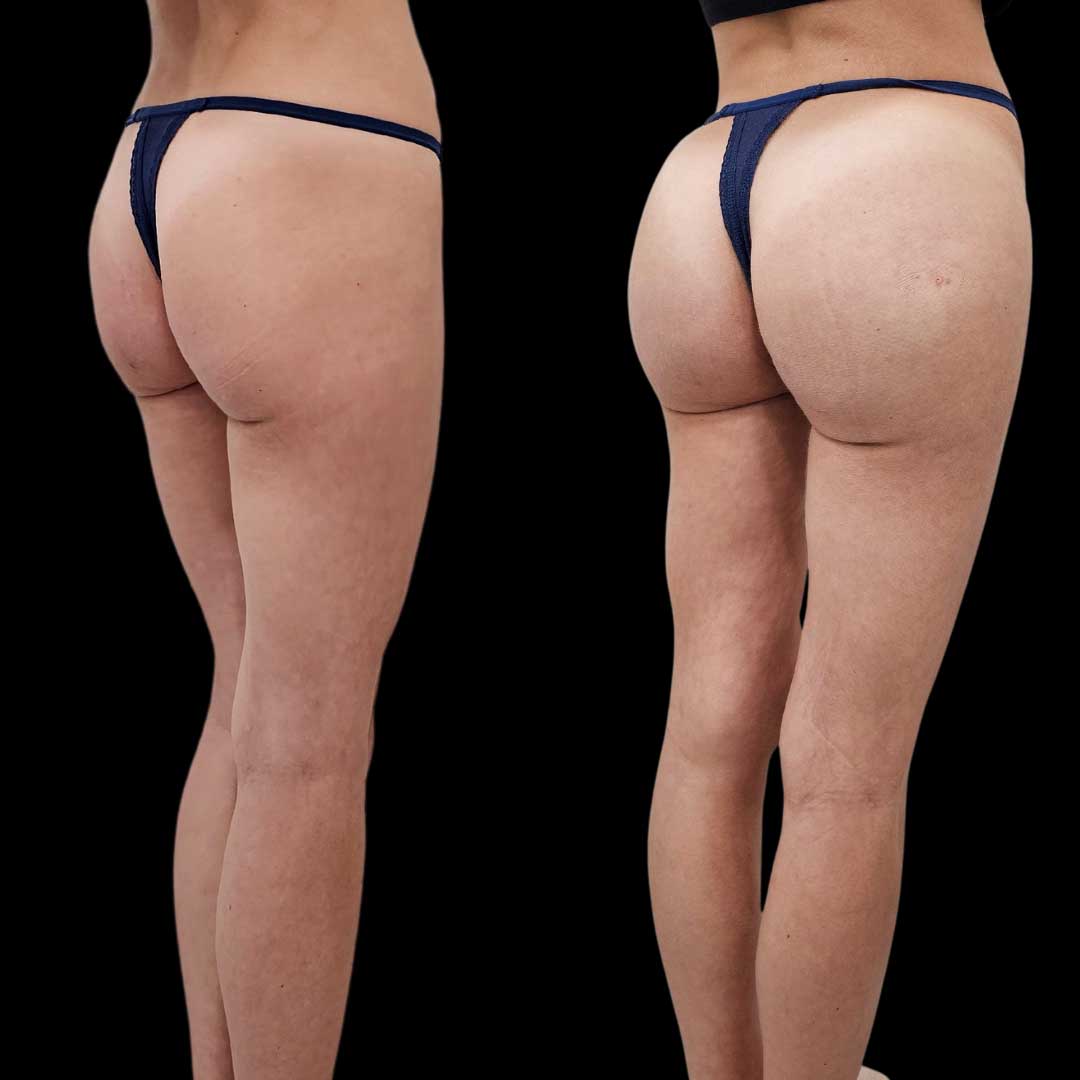 Non-Surgical Butt Lift and Cellulite Reduction in NYC: HydraSculpt & Avéli
